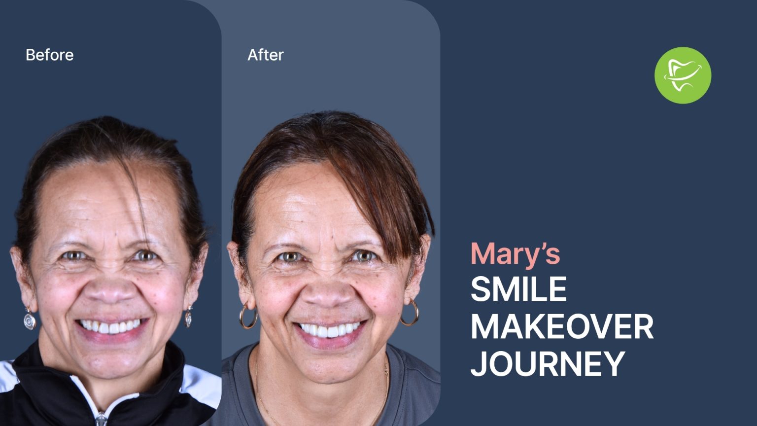 Smile Makeover Notting Hill: How Mary Transformed Her Smile with ...
