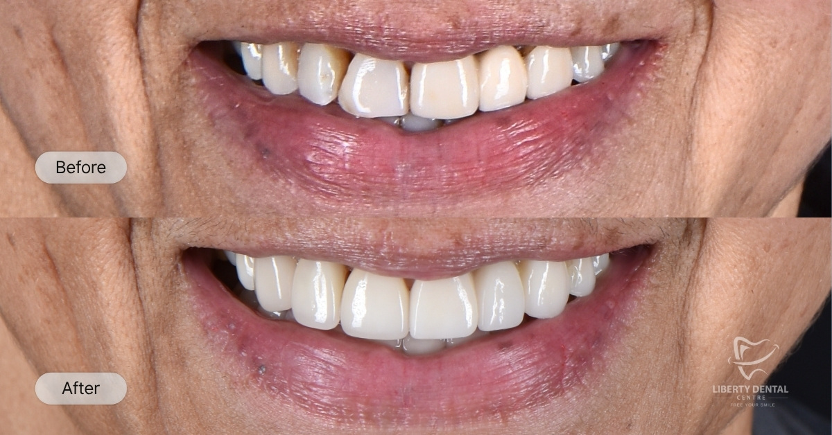 Smile Makeover Notting Hill: How Mary Transformed Her Smile with ...