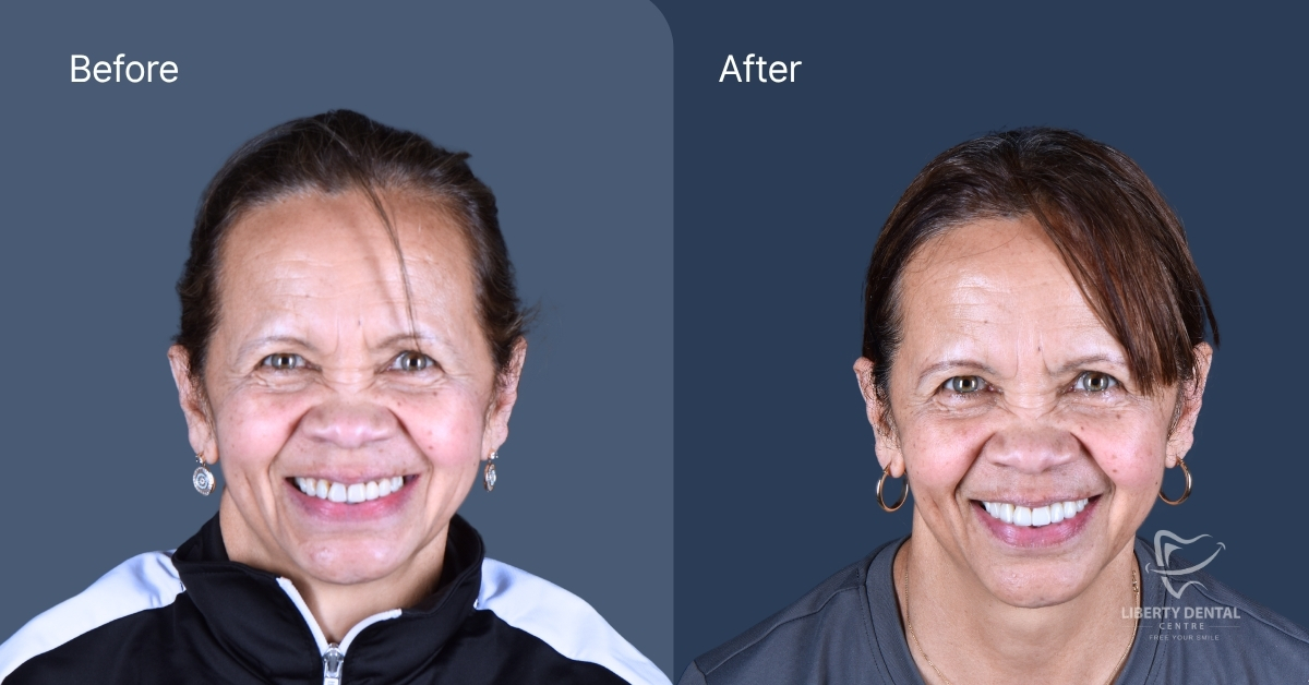 Smile Makeover Notting Hill: How Mary Transformed Her Smile with ...